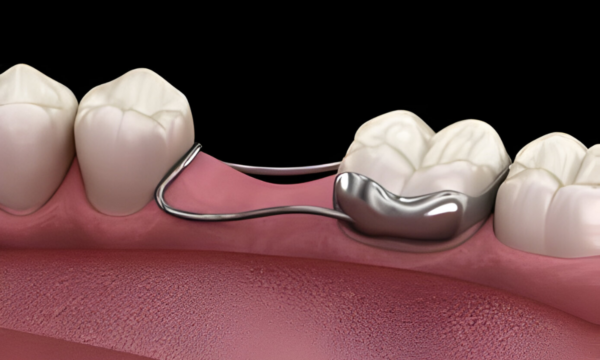 What are Space Maintainers and what are their advantages?