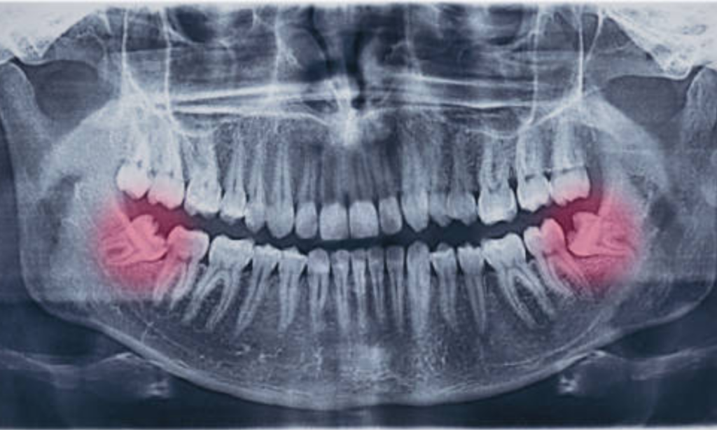 What to Expect During a Wisdom Tooth Extraction Procedure