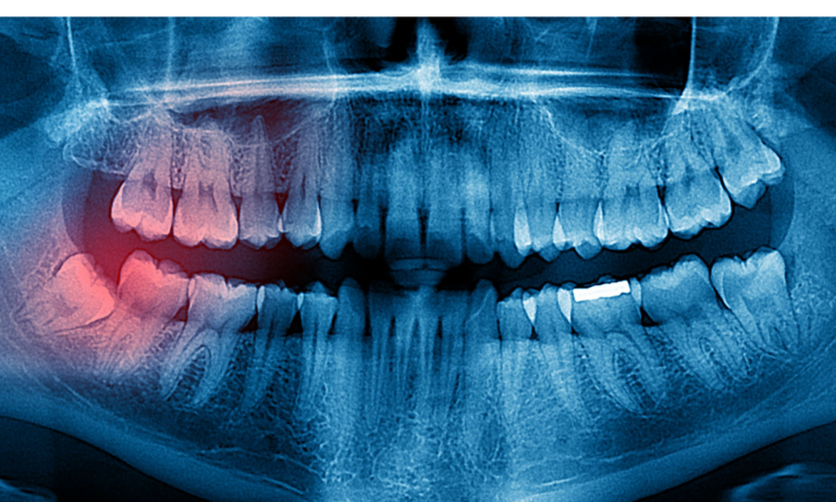 Wisdom Tooth Infection: 10 Warning Signs To Watch Out For | Growing Smiles