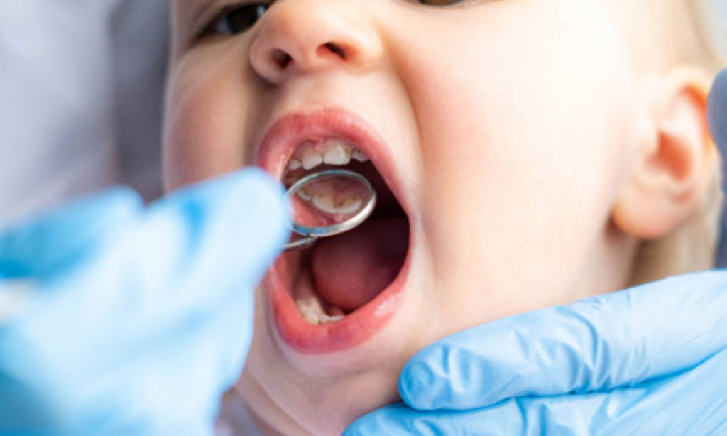 Bottle Feeding Tooth Decay: Causes, Prevention, and Solutions - Growing ...